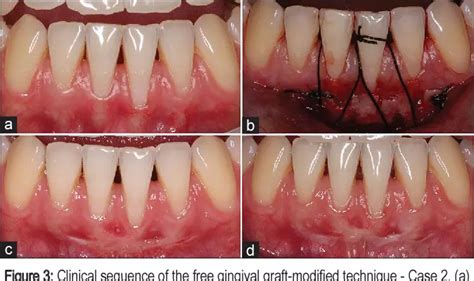 Keratinized Tissue Width Augmentation Enhances Clinical And Esthetic Outcomes Using Fgg And Lcc
