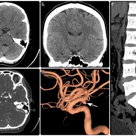 Axial Unenhanced Computed Tomography Ct Scan Of The Brain A Axial