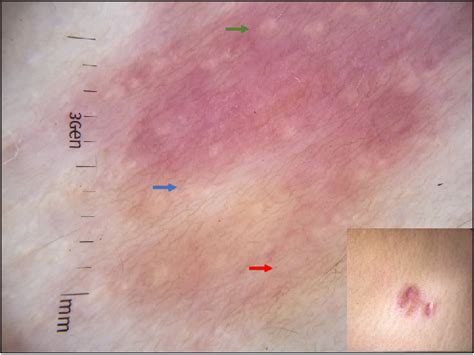 Dermoscopy Of Dermatofibrosarcoma Protuberans In Skin Of Colour A
