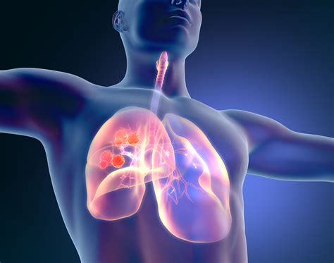 Surgery And Radiation May Have Similar Quality Of Life Outcomes In Lung