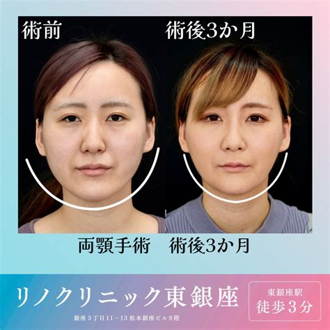 面長感を変える骨切り【両顎手術・輪郭整形】術後3か月｜骨切りドクター宮崎