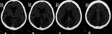 A ± D Ct Of The Patients Brain At Admission Showing A Pre Existing