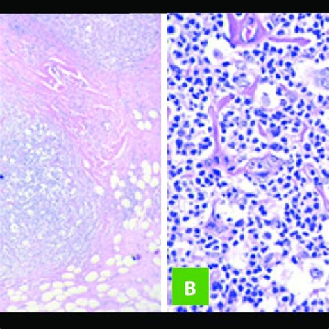 Nodular Sclerosing Type A Dense Hyaline Collagen Bands And Nodular Download Scientific