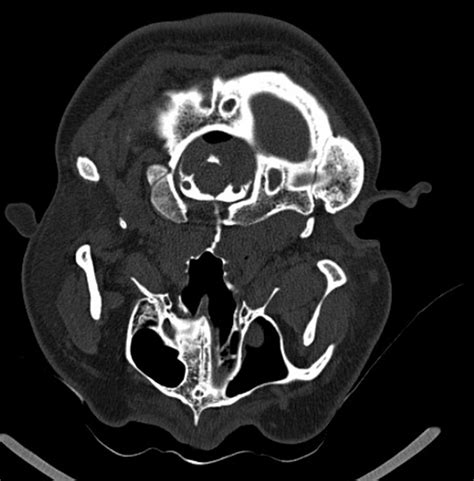 Ct Cisternogram 10 Ml Of Non Ionic Contrast Media Injected Into Sub