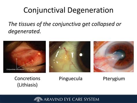 Diseases And Disorders Of Conjunctiva Pptx
