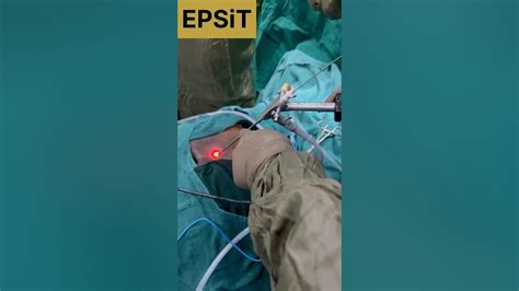 Endoscopic Pilonidal Sinus Treatmentepsit Laser Treatment For