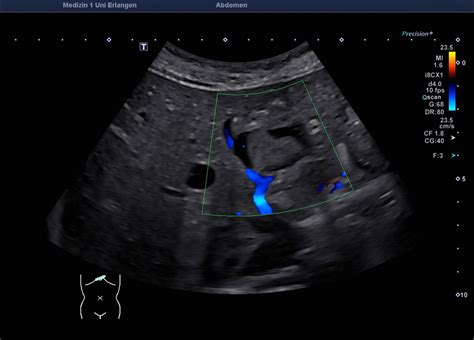 Complex Liver Cyst Series Of Images Atlas Of Ultrasound