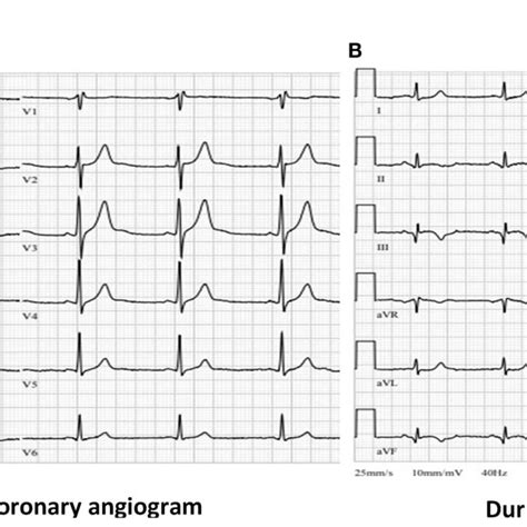 Figure E A Post Procedural Ecg From Icu Showing Resolution Of Download Scientific Diagram