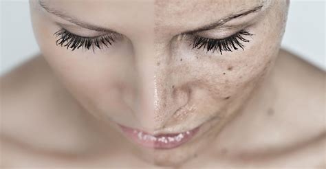 Have You Got A Dirty Face No Thats Just My Hyperpigmentation