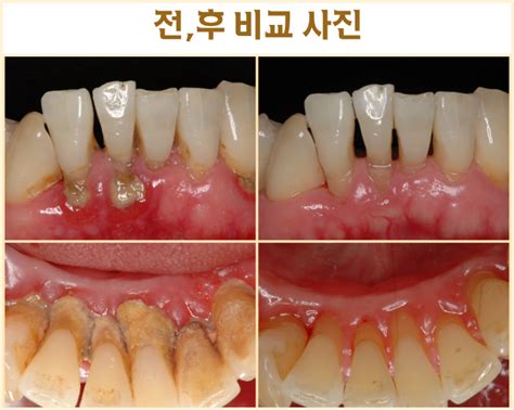 잇몸 출혈 방치했다간 자연치 수명까지 단축시킨다 노블리안치과의 치주치료 과정 네이버 블로그