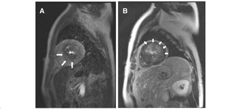 Focal Blot Like Adenosine Stress Induced Perfusion Defect On Cmr And