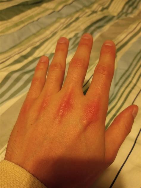 Red Knuckles Rdermatologyquestions