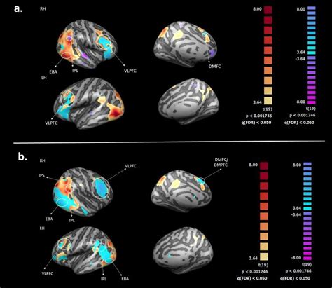 A Whole Brain Mvpa And Univariate Results Overlap Combined Map Of Download Scientific