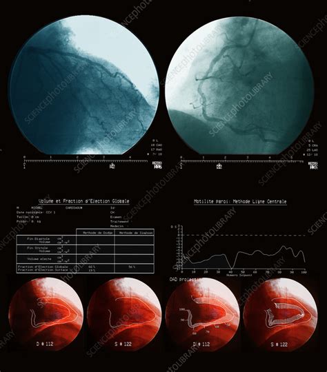 Cardiac Output Examinations X Ray Stock Image C0580239 Science