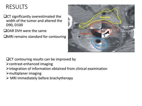 Image Guided Brachytherapy Carcinoma Cervix Pptx