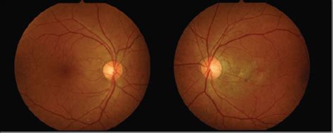 Pseudoxanthoma Elasticum Eye