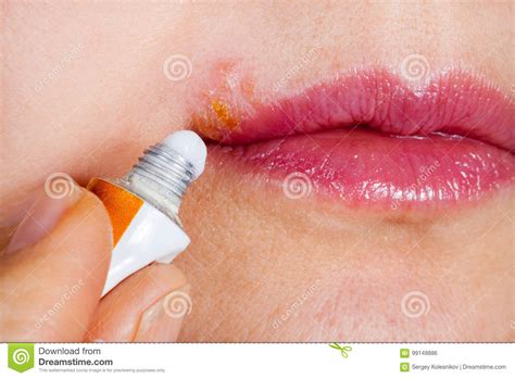 Herpes On The Lip Close Up Macro Woman Lubricates The Labial Herpes