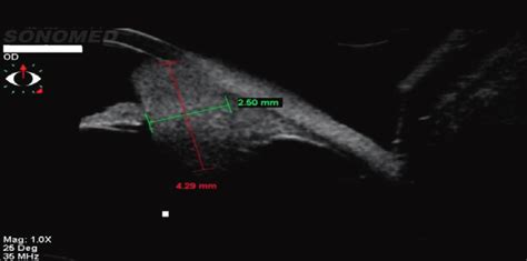 Ubm Showed A Solid Mass With High Medium Reflectivity And Loss Of The