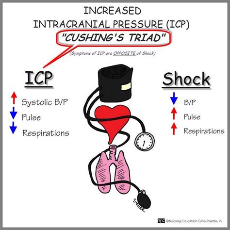 What Is Intracranial Pressure Icp At Natosha Guerro Blog