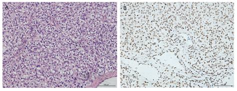 Rare Ovarian Steroid Cell Tumor Not Otherwise Specified Nos With