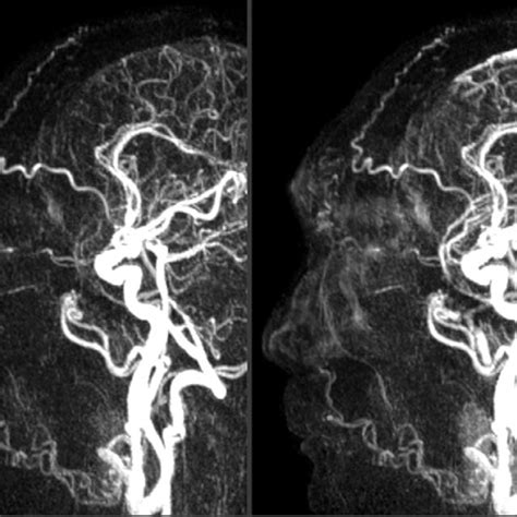 Sagittal View Of Gadolinium Enhanced T1 Weighted Mri A And 4d Mr