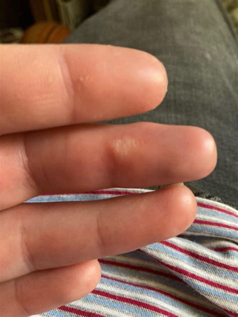 Ulcer Update A Few Months Later R Scleroderma