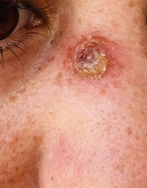 Possible Infected Pimples Rskin