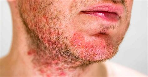 Los 5 Tipos De Foliculitis Causas Y Tratamiento