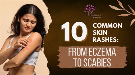 10 Common Skin Rashes From Eczema To Scabies Best Nephrologist And