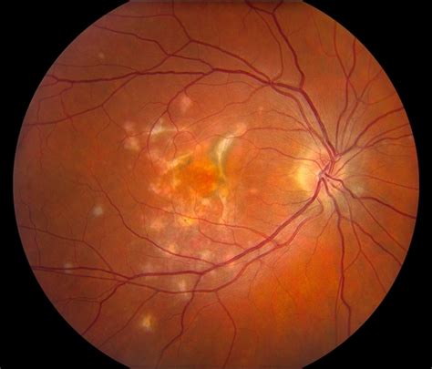 Multifocal Choroidits Vitiligo Vogt Koyanagi Harada Syndrome