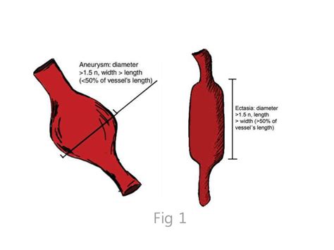 Fusiform Ectasia Of Abdominal Aorta