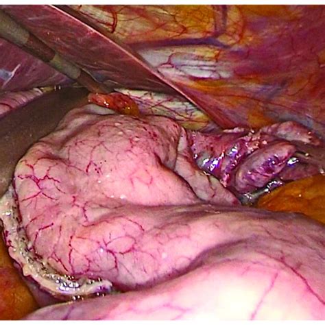 Gastric Specimen After Sleeve Gastrectomy Red Arrows Neck Of The Download Scientific Diagram