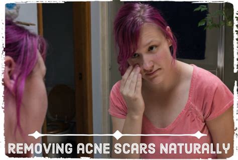 5 Home Remedies To Remove Deep Acne Scars Hubpages