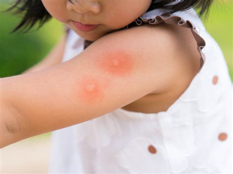 Dengue Fever Rash Face