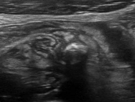 Pediatrics 91 Pediatric Abdomen And Retroperitoneum Case 917