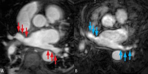 Improved Left Atrial Imaging In Atrial Fibrillation Patients Using Novel Ecg Gated Vs