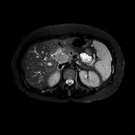 Distal Common Bile Duct Cbd Cholangiocarcinoma Body Mr Radiology
