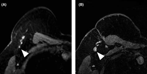 Axillary Lymph Nodes Mri