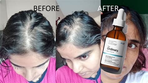 The Ordinary Hair Serum Review Before After Multi Peptide Serum
