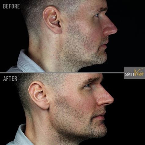 Volux™ Improve Your Jawline Today La Chelé