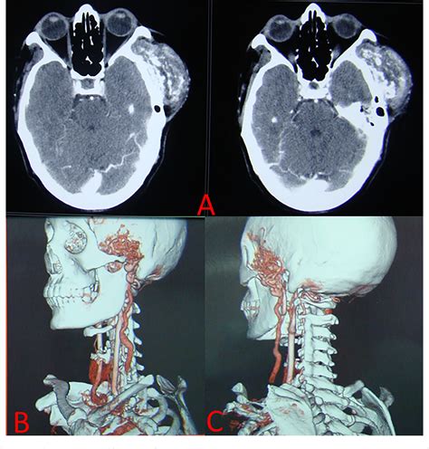 Figure 1 From Surgical Management Of Scalp Arteriovenous Malformations Using A Novel Surgical
