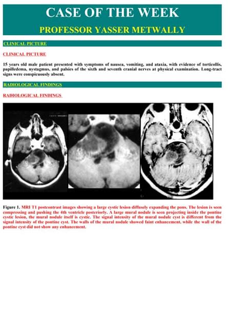 Case Recordbrain Stem Pilocytic Astrocytoma Pdf