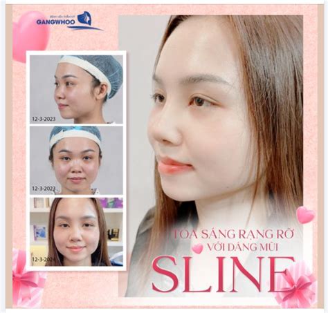 Một Chiếc Mũi Cao đẹp Tự Nhiên Thay đổi Nhan Sắc Của Bạn Như Thế Nào