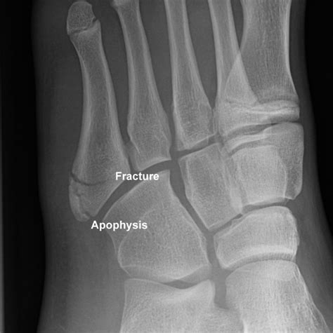 Ankle And Foot Emcage