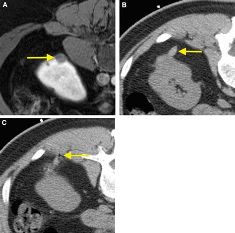 Separate Session Renal Mass Biopsy For A 64 Year Old Man With A Small