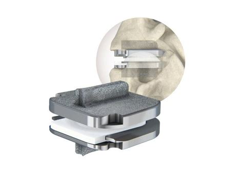 Centinel Spine Completes First Use Of Prodisc C Sk Cervical Tdr Device