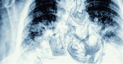 Who Needs To Be Screened For Lung Cancer Tallahassee Memorial Health