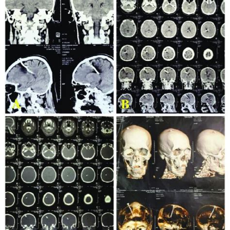 Patient Head Ct Scan Pre Operation A D Download Scientific Diagram
