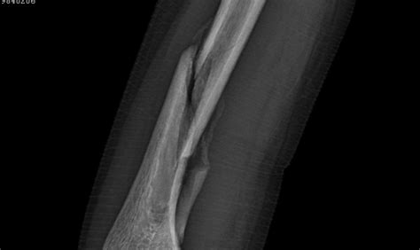 Spiral Fracture Causes Contentbatman