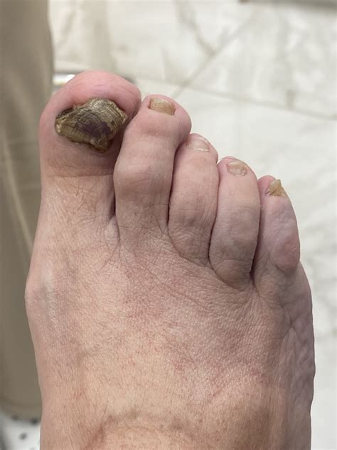 օնիխոդիստրոֆիա`օնիխոգրիֆոզ — «Պրոֆ Հ Ա Քալամքարյանի անվան Մաշկավեներաբանության և մաշկի